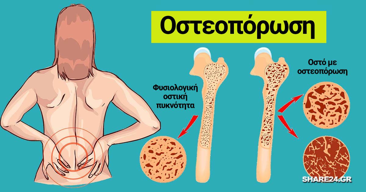 Οστεοπόρωση : Άσκηση, διατροφή και ομοιοπαθητική | Υγεία και Ευεξία