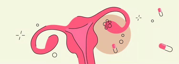 Μετφορμίνη για PCOS: Τι πρέπει να γνωρίζετε | Υγεία και Ευεξία